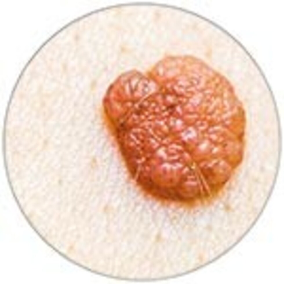 Los lunares peligrosos y el cáncer, tips para detectarlos